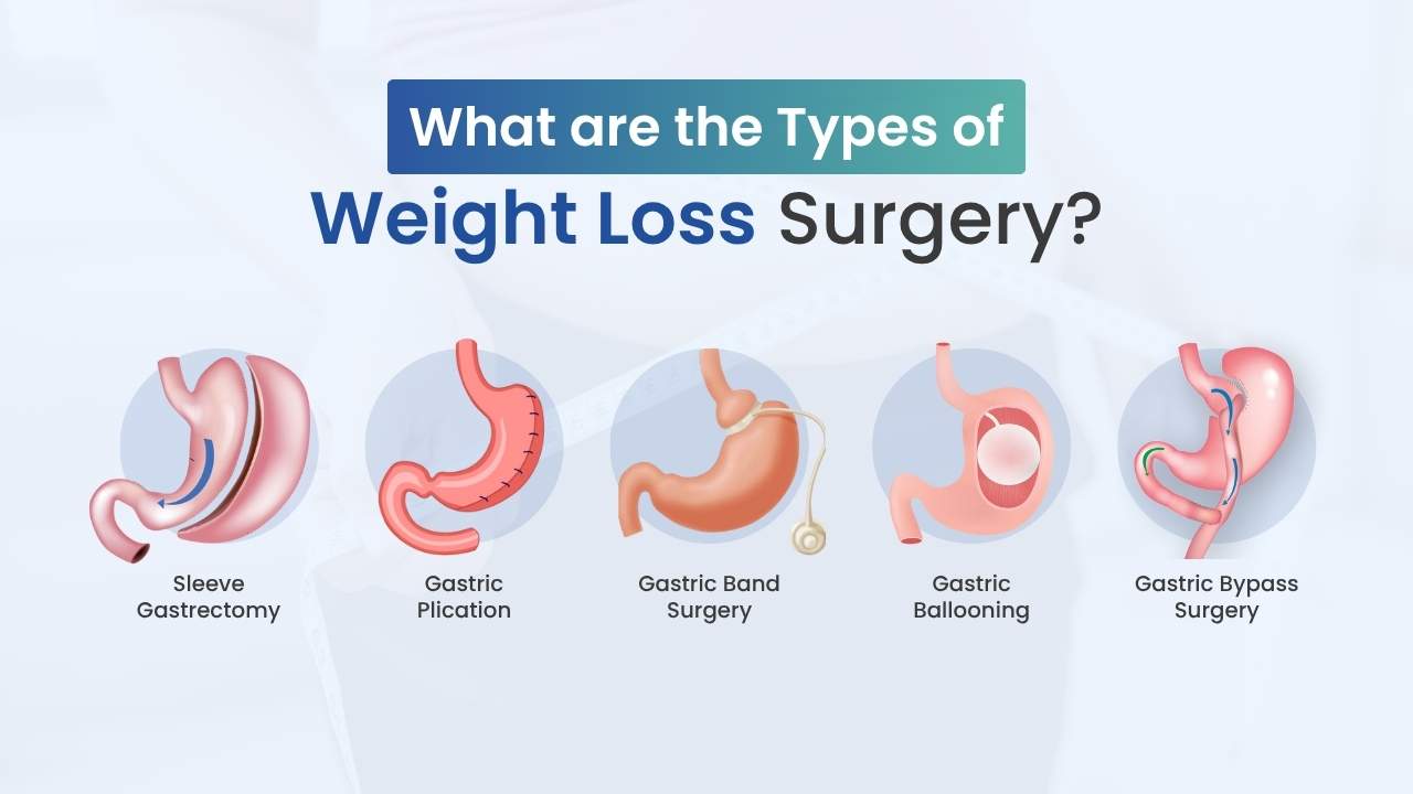 Cheapest Weight Loss Surgery Without Insurance | Low-Cost Options