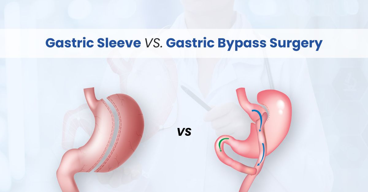 Gastric Sleeve Surgery Explained | What You Should Know Before Choosing It