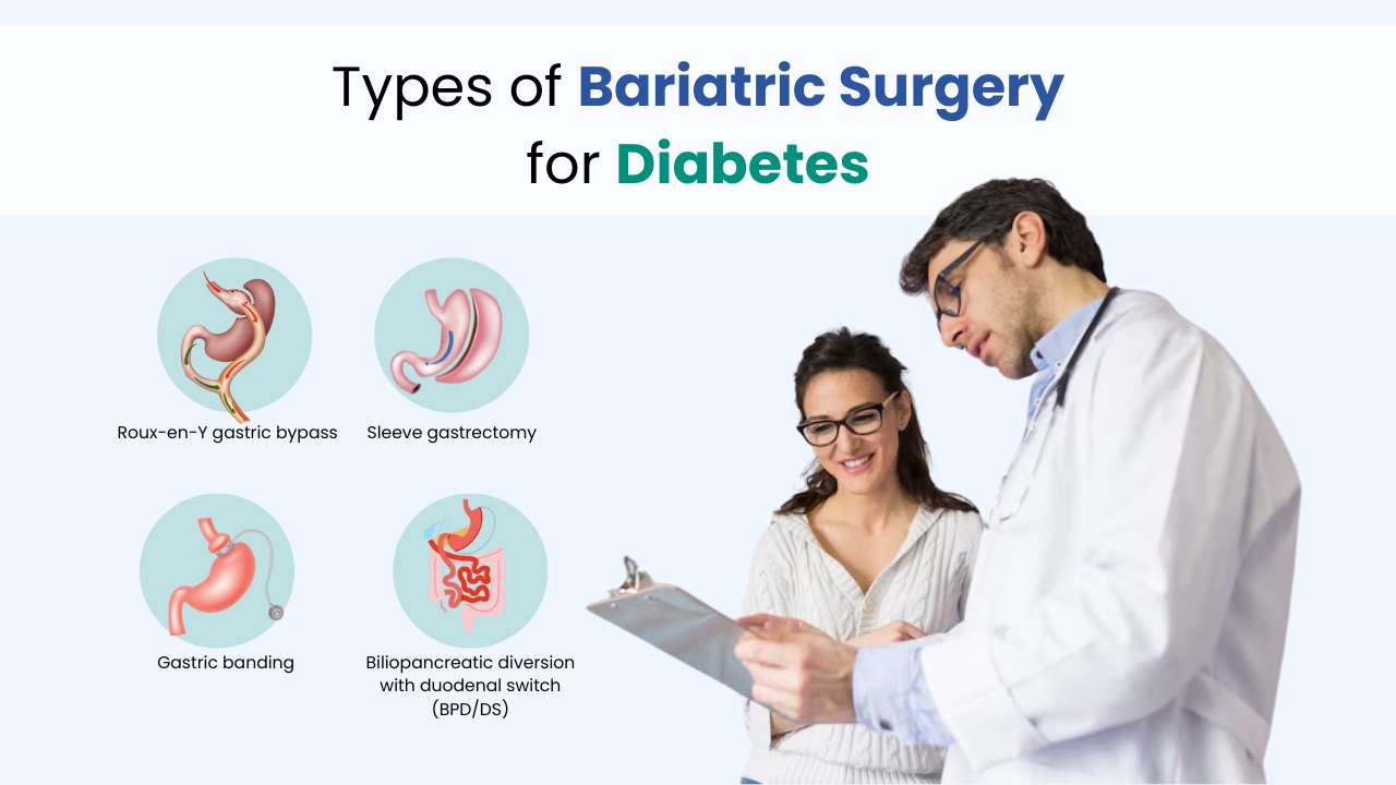 Which Bariatric Surgery is Best for Type 2 Diabetes