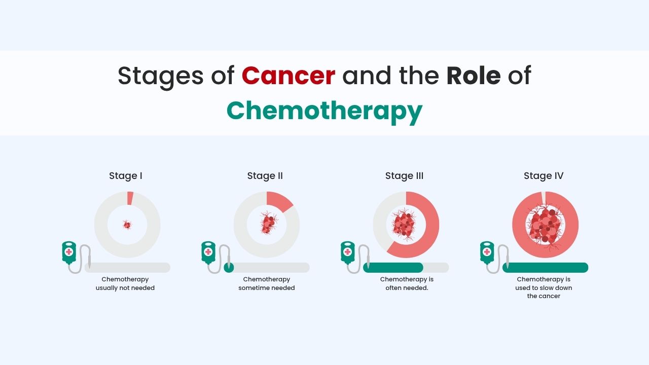 At What Stage of Cancer Is Chemotherapy Needed?