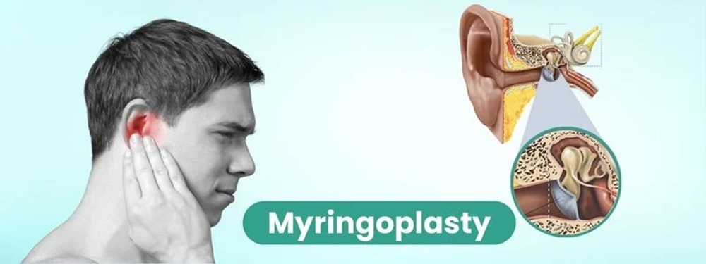 Myringoplasty Cost in India | RIHLATMED